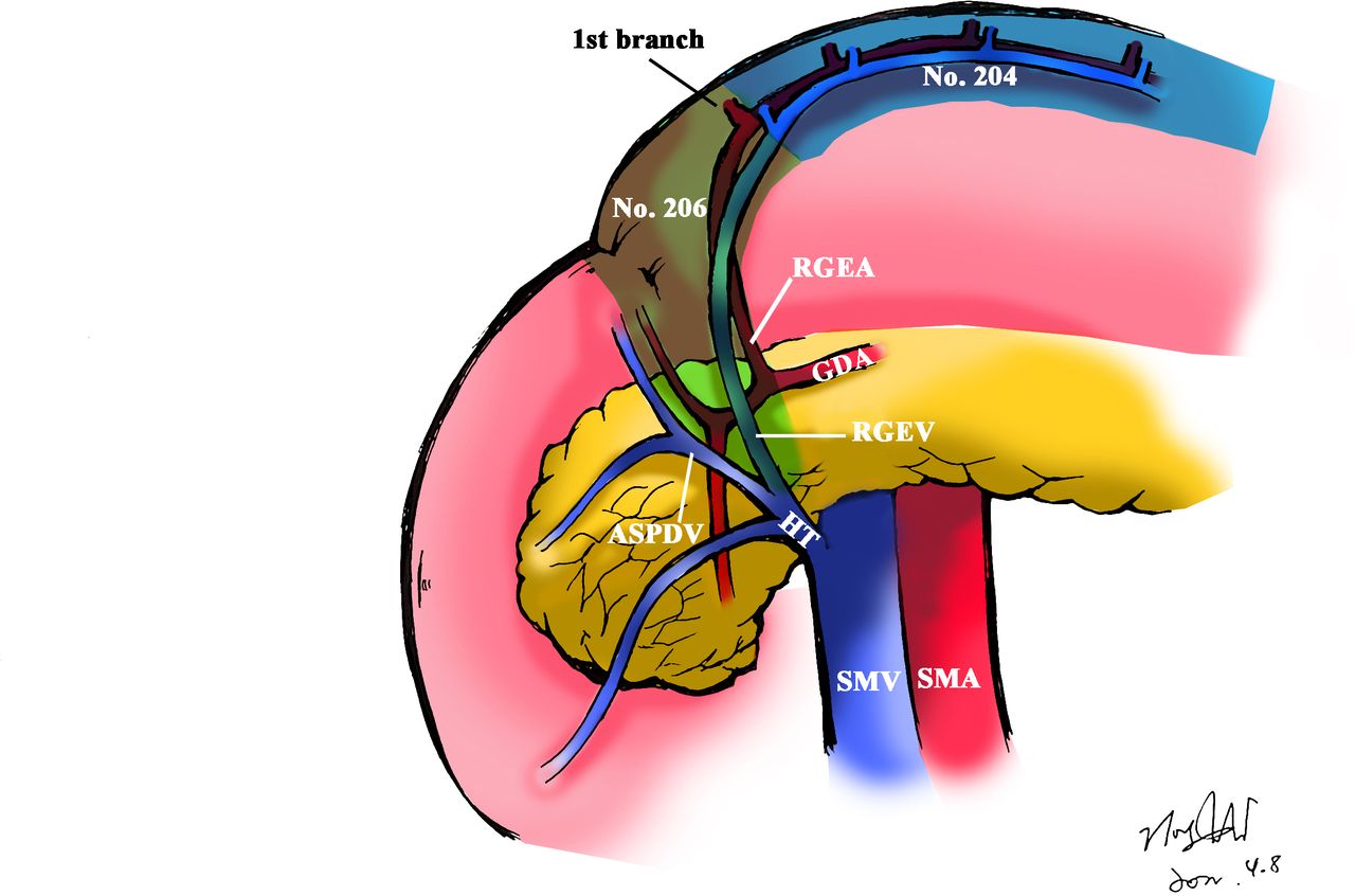 Infrapyloric (No. 206) and greater curvature (No. 204) lymph node ...