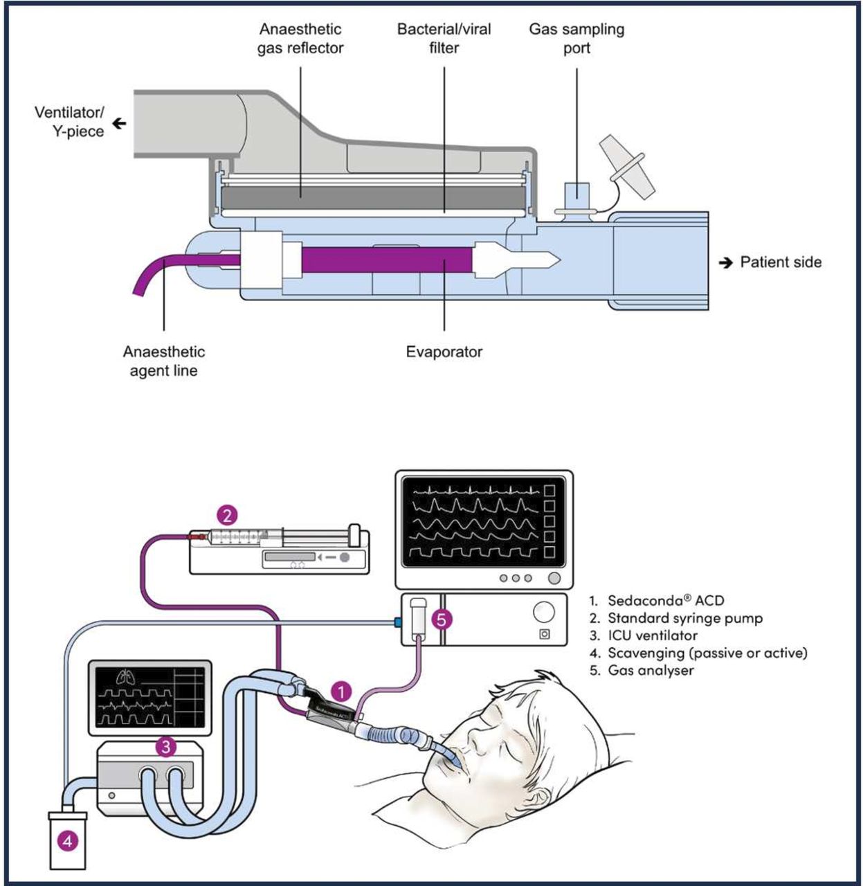 INhaled Sedation versus Propofol in REspiratory failure in the ...